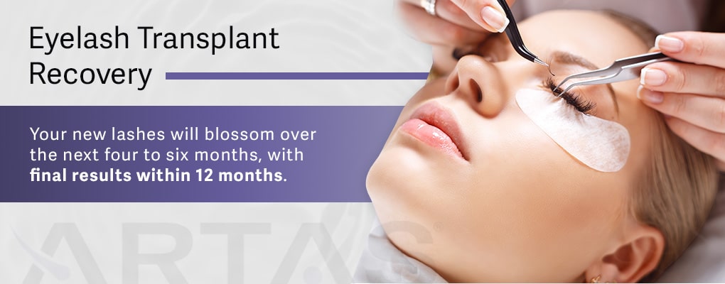 Eyelash Transplant Pros & Cons | Permanent Lash Solutions
