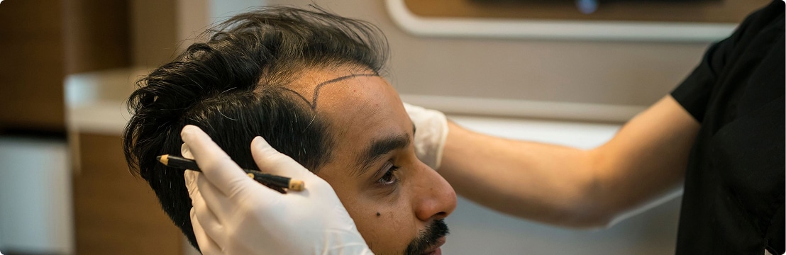 Expert Hair Transplant Procedures | Hair Restoration Center