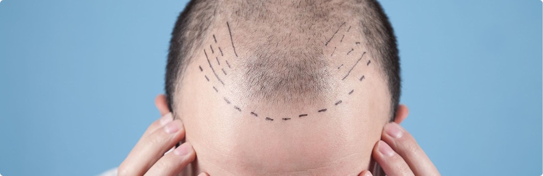 Hair Transplant Bay Area